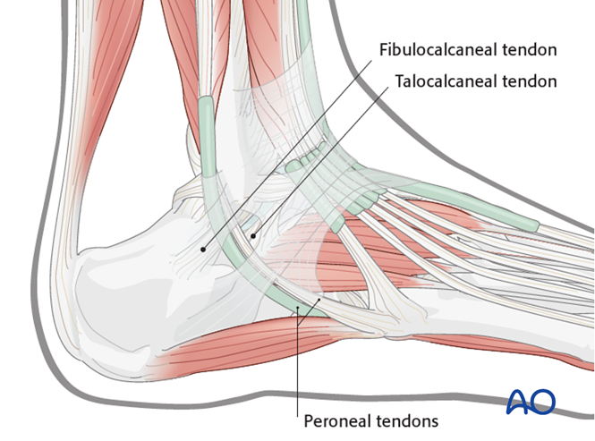 Extended lateral approach to the calcaneus