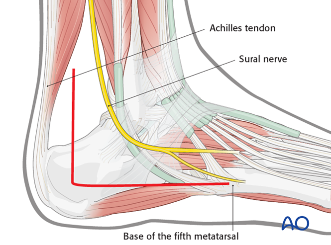 Extended lateral approach to the calcaneus