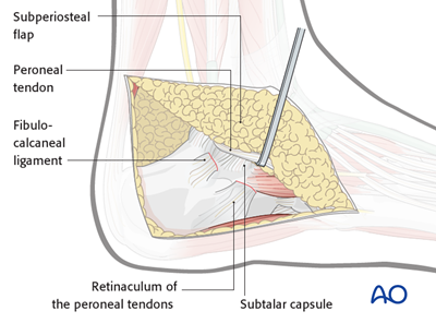Extended lateral approach to the calcaneus