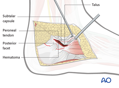 Extended lateral approach to the calcaneus