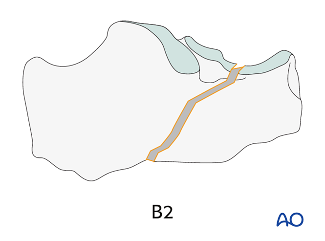 Displaced fracture of the calcaneus body