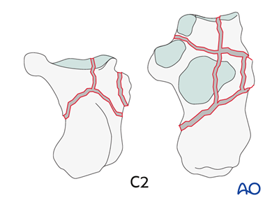 Displaced fracture of the calcaneus body