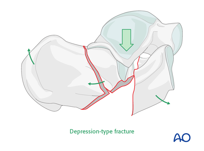 Extreme tongue-type (beak) fracture of the calcaneus body