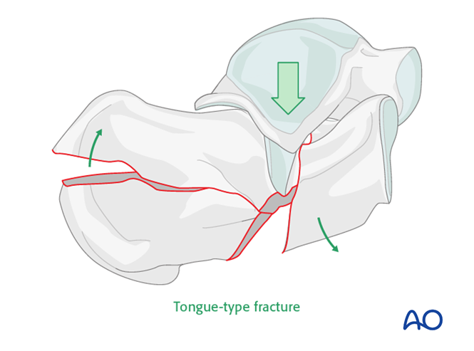 Extreme tongue-type (beak) fracture of the calcaneus body