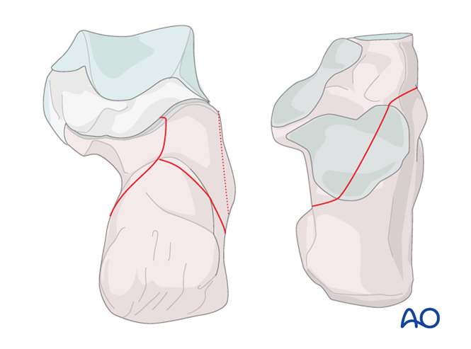 Simple undisplaced fracture of the calcaneus body