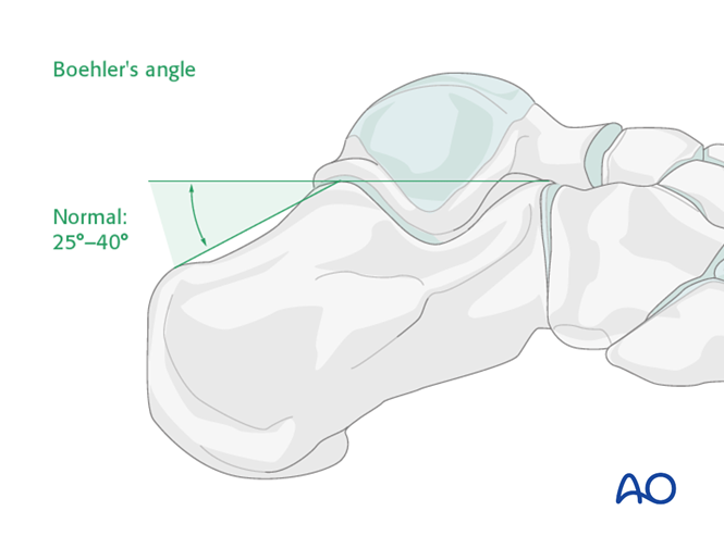 Simple undisplaced fracture of the calcaneus body