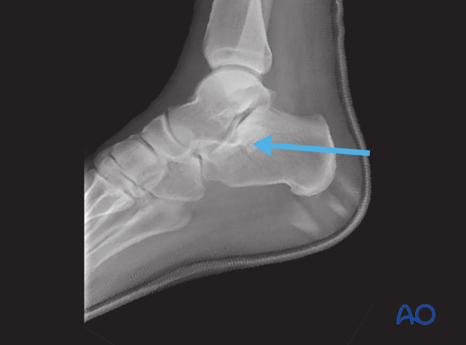 Medial approach to the calcaneus