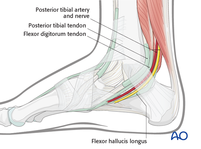 Medial approach to the calcaneus