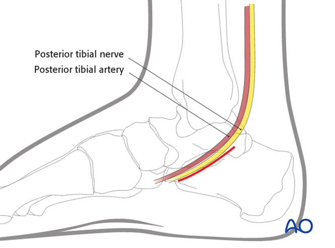 Medial approach to the calcaneus