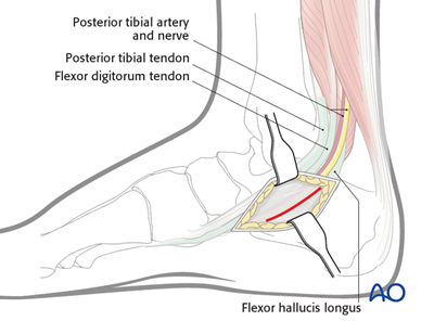 Medial approach to the calcaneus