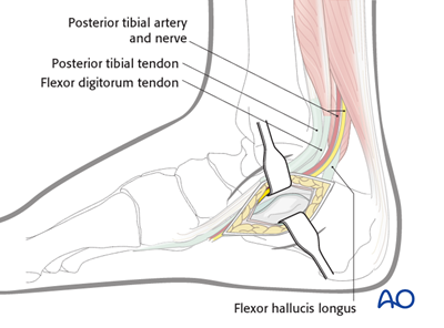 Medial approach to the calcaneus