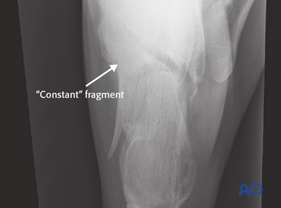 ORIF - Plate and screw fixation for Displaced fracture of the calcaneus ...