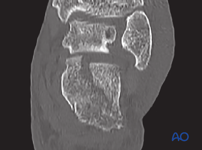ORIF - Plate and screw fixation for Displaced fracture of the calcaneus ...