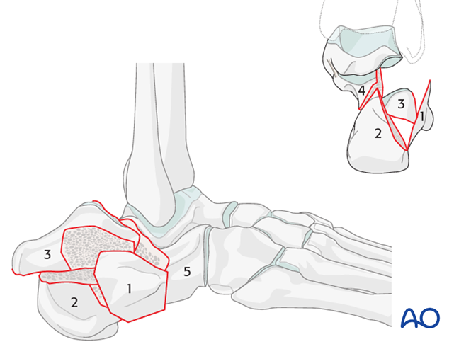 ORIF - Plate and screw fixation for Displaced fracture of the calcaneus ...