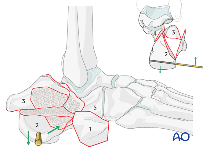 ORIF - Plate and screw fixation for Displaced fracture of the calcaneus ...