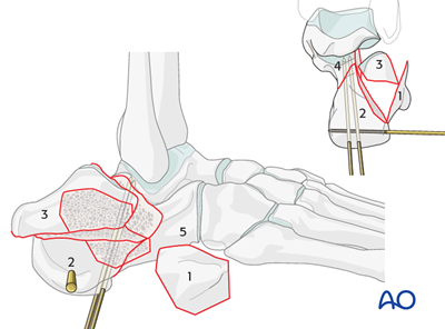 ORIF - Plate and screw fixation for Displaced fracture of the calcaneus ...