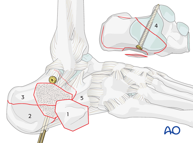ORIF - Plate and screw fixation for Displaced fracture of the calcaneus ...