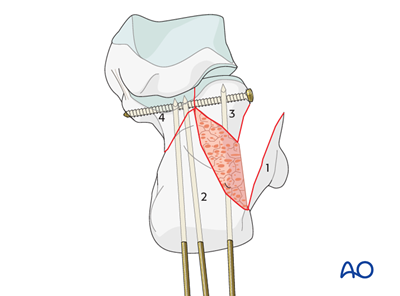 ORIF - Plate and screw fixation for Displaced fracture of the calcaneus ...