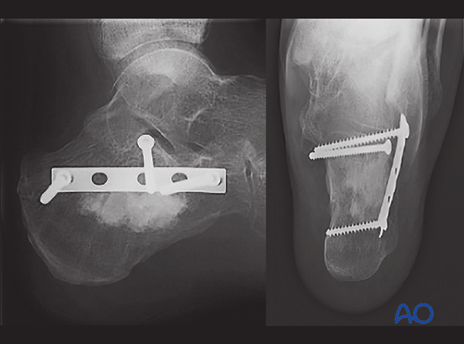 ORIF - Plate and screw fixation for Displaced fracture of the calcaneus ...
