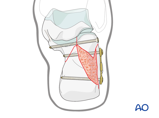 ORIF - Plate and screw fixation for Displaced fracture of the calcaneus ...