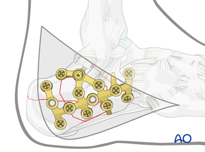 ORIF - Plate and screw fixation for Displaced fracture of the calcaneus ...