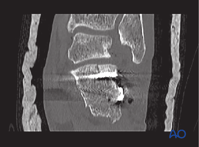ORIF - Plate and screw fixation for Displaced fracture of the calcaneus ...
