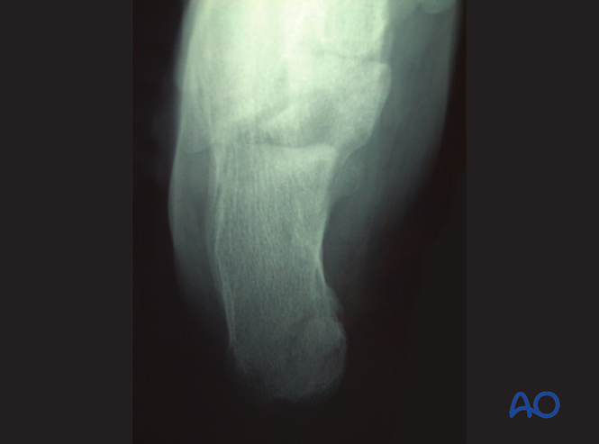 ORIF - Screw fixation for Extreme tongue-type (beak) fracture of the ...