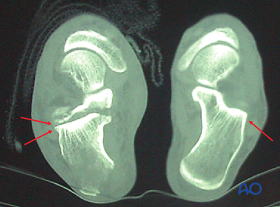 Extreme tongue-type (beak) fracture of the calcaneus body