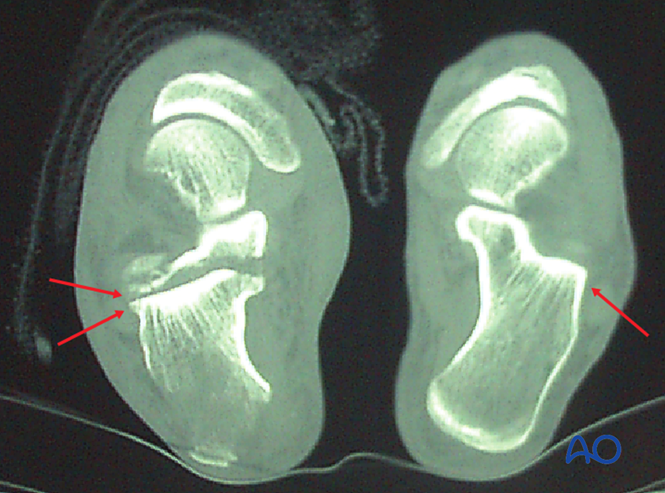 ORIF - Screw fixation for Extreme tongue-type (beak) fracture of the ...