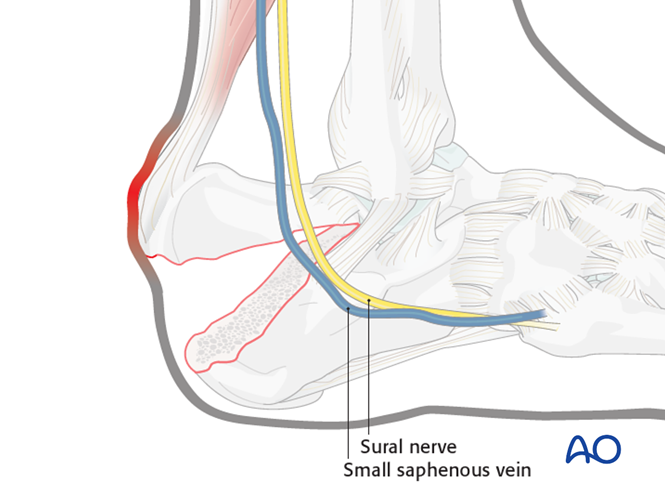 Extreme tongue-type (beak) fracture of the calcaneus body