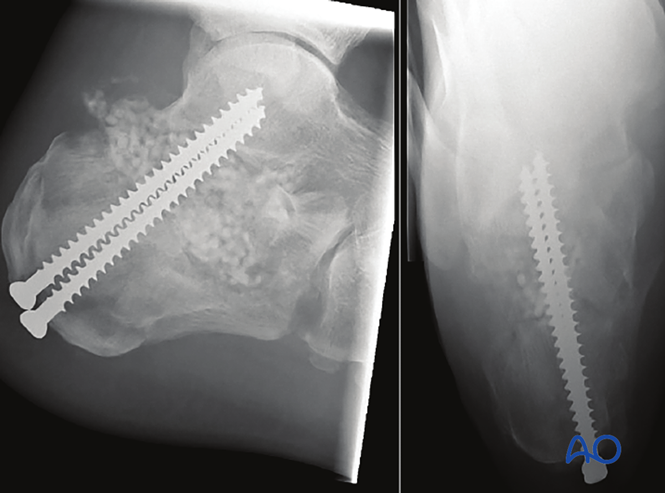 ORIF - Plate and screw fixation for Displaced fracture of the calcaneus ...