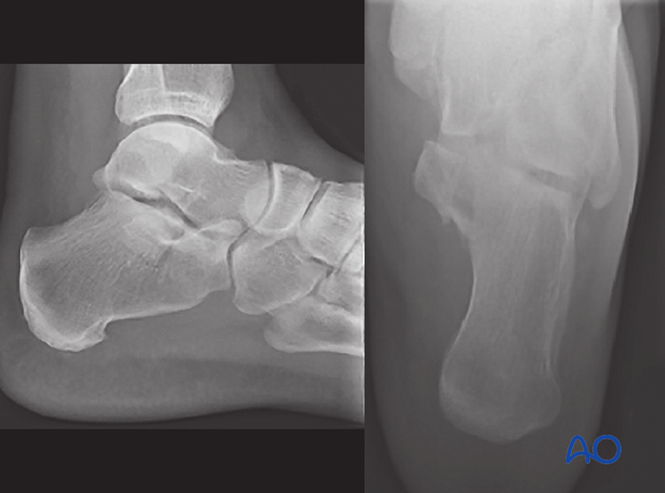 ORIF - Screw fixation for Sustentacular fracture of the calcaneus body