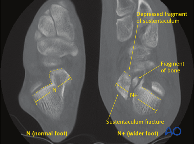 ORIF - Screw fixation for Sustentacular fracture of the calcaneus body