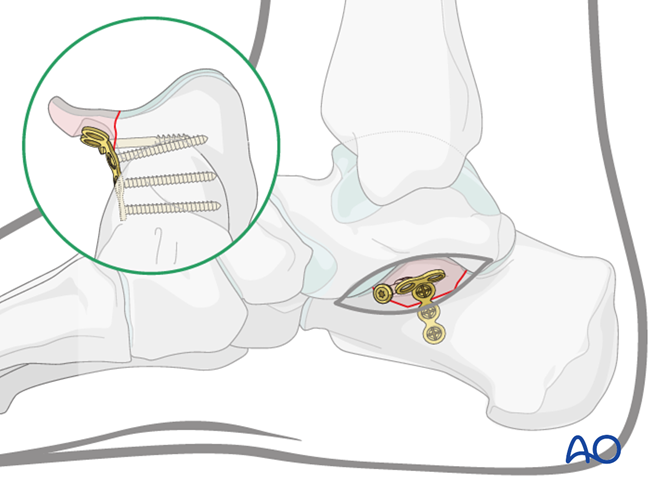 ORIF - Screw fixation for Sustentacular fracture of the calcaneus body