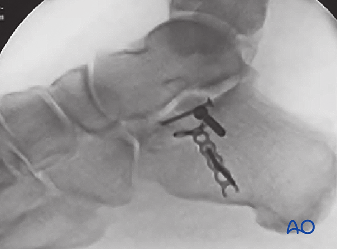 ORIF - Screw fixation for Sustentacular fracture of the calcaneus body