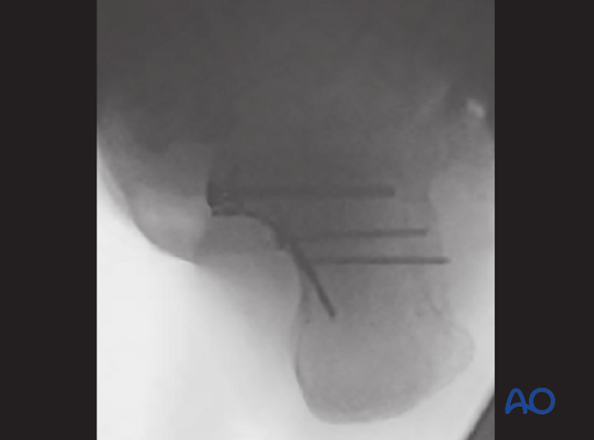 ORIF - Screw fixation for Sustentacular fracture of the calcaneus body