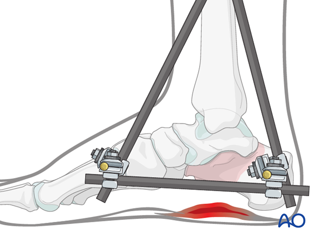 Open fractures