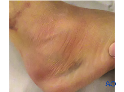 Sinus tarsi approach to the calcaneus