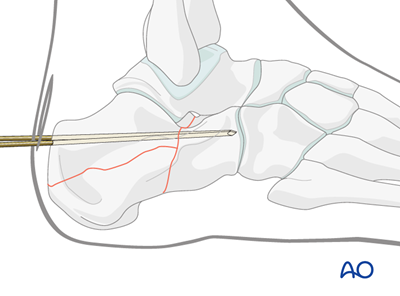 MIO - K-wire fixation (tongue type) for Displaced fracture of the ...