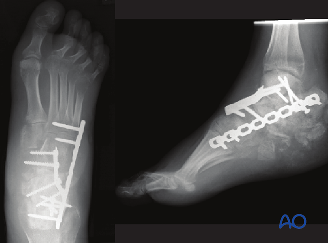 Combined hindfoot injuries