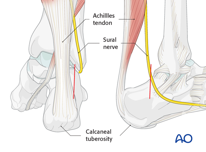 MIO posterior approach to the calcaneus