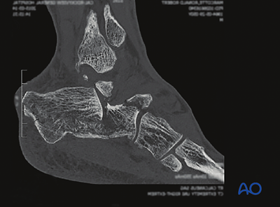 Sinus tarsi approach to the calcaneus