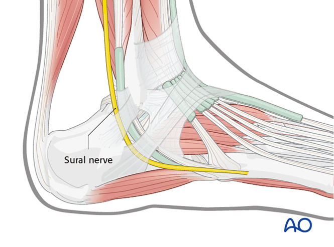 Sinus tarsi approach to the calcaneus