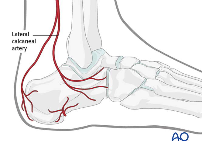 Sinus tarsi approach to the calcaneus