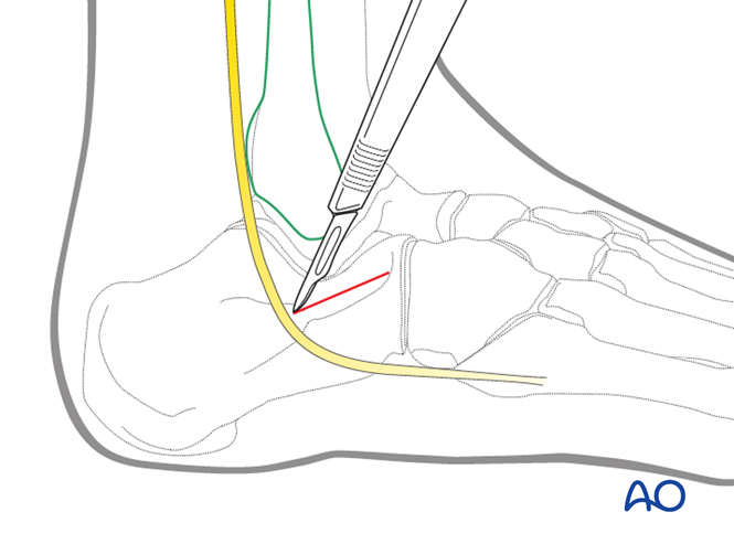 Sinus tarsi approach to the calcaneus