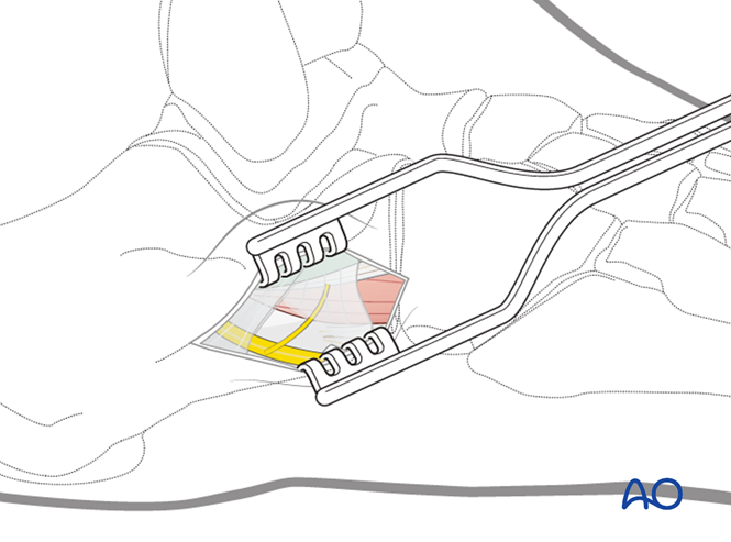 MIO lateral approach to the calcaneus