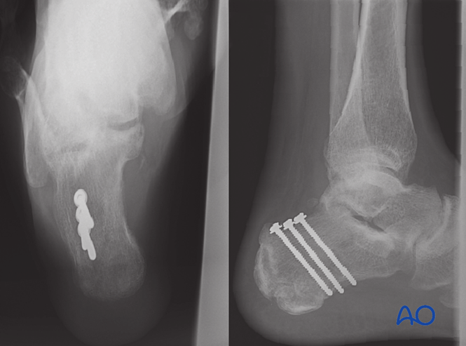 ORIF - Screw fixation for Extreme tongue-type (beak) fracture of the ...