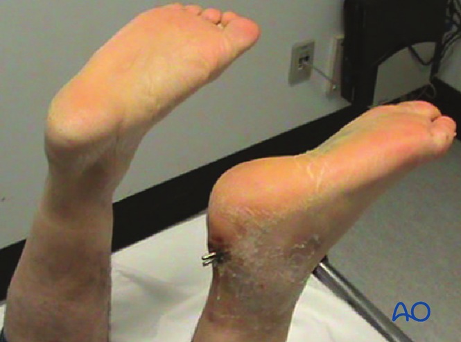 MIO - K-wire and screw fixation (joint-depression type) for Displaced ...