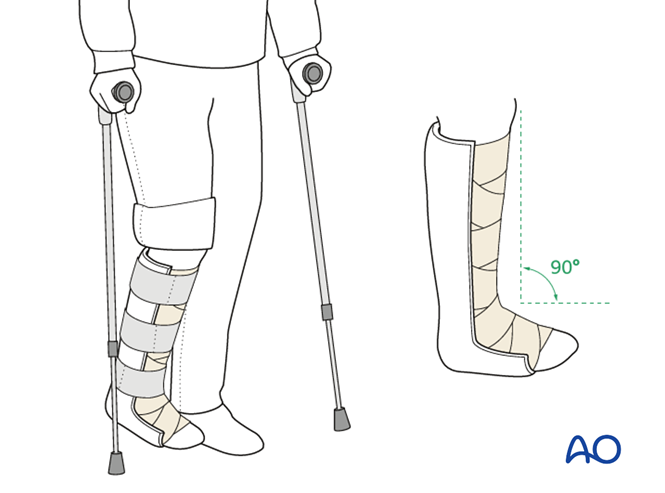 ORIF - Plate and screw fixation for Displaced fracture of the calcaneus ...