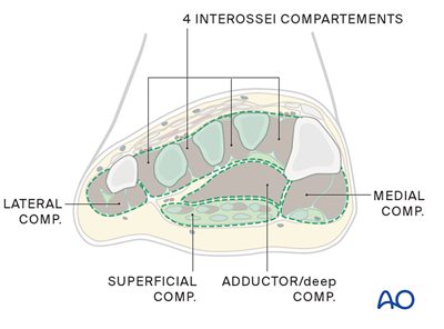 Compartment syndrome of the foot
